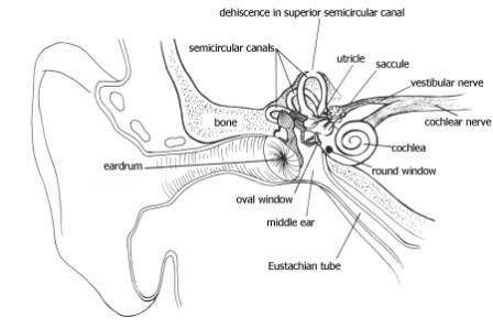 Superior Semicircular Canal Dehiscence (SSCD) | Vestibular Disorders ...