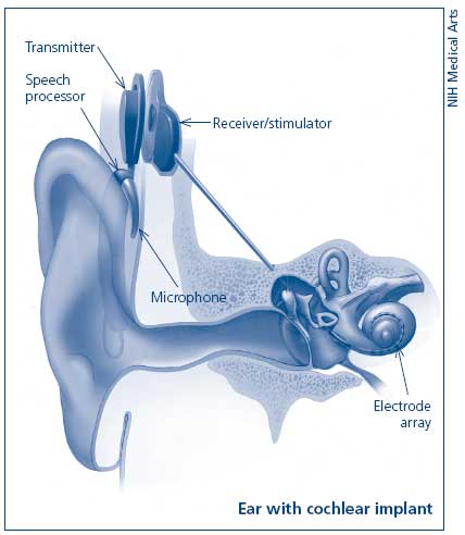 Cochlear Implantation in Ménière’s Disease - Vestibular Disorders ...